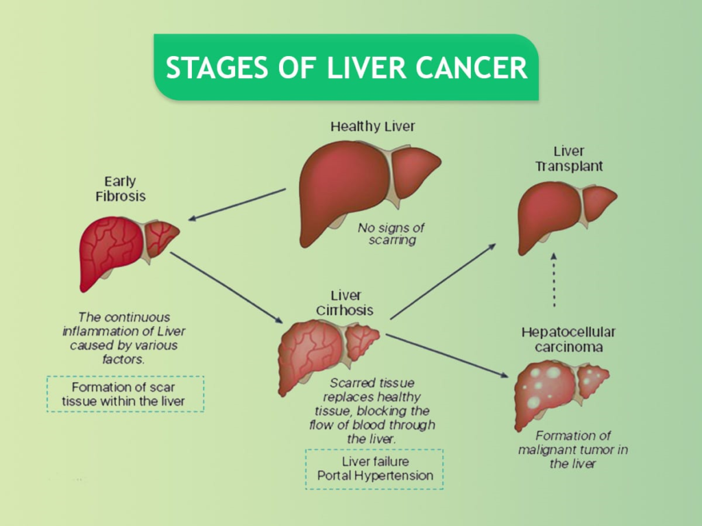 World Liver Day: Taking Care of Your Body's Powerhouse with Zeon ...